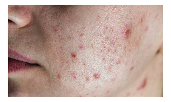 Acne Treatment – Chicago Cosmetic Surgery & Dermatology
